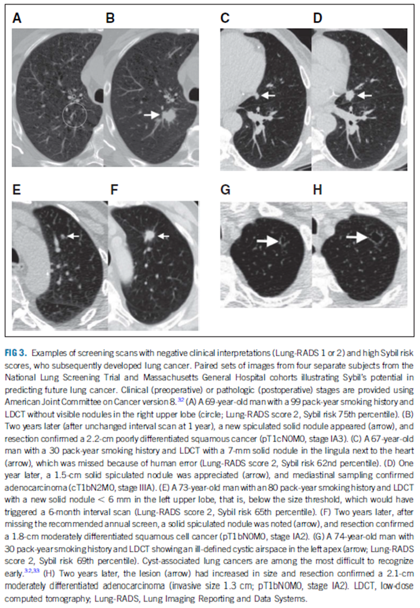 Sybil：基于单次LDCT预测未来肺癌风险的深度学习模型