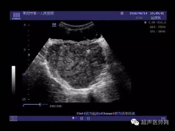 超声典型病例【前列腺癌】