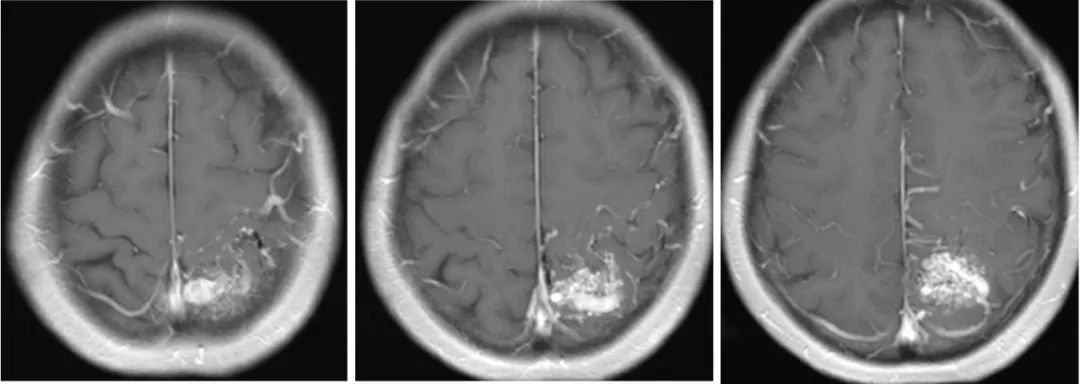 【神外视界】何升学教授：AVM的一例手术治疗（二）