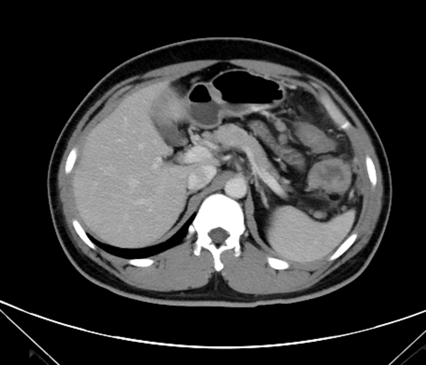 结肠癌术前免疫治疗病例分享