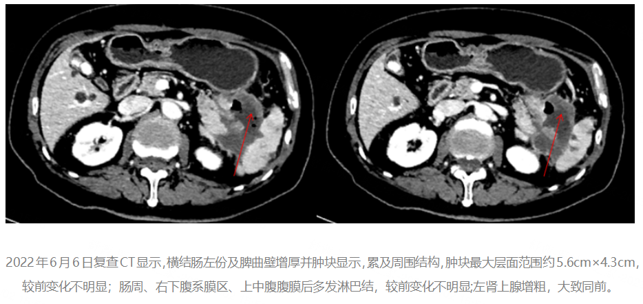 【有言在先】肿瘤分期达T4b，累及患者多个器官，看李云峰教授如何点评？