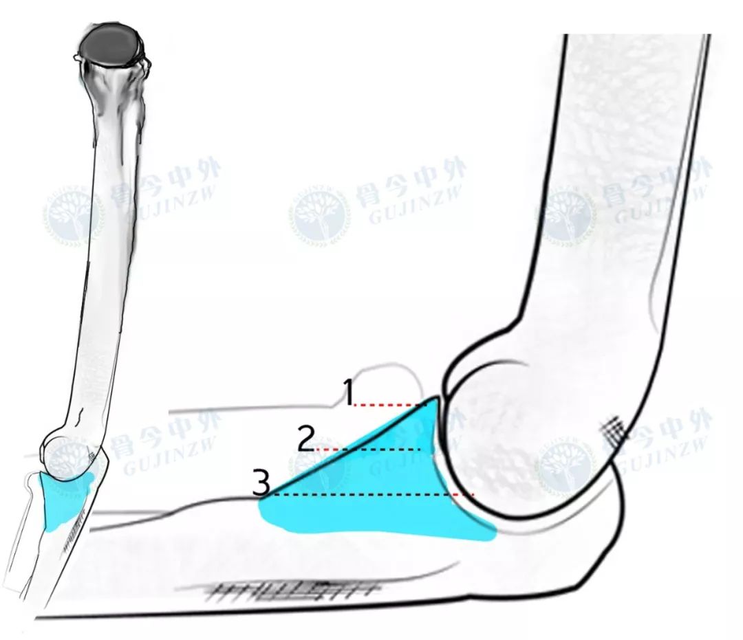 收藏备用系列：骨科常见的骨折分型大全下篇