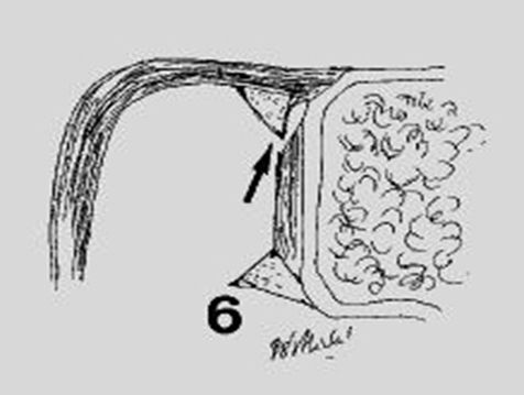 今天，我跟肩关节SLAP损伤彻底杠上了！