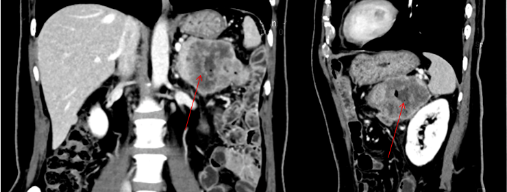 【有言在先】肿瘤分期达T4b，累及患者多个器官，看李云峰教授如何点评？