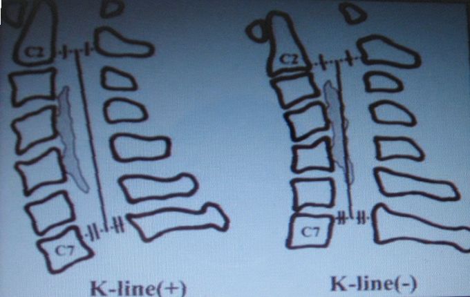 实用技巧：脊柱常用测量方法及临床意义