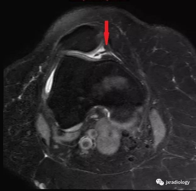 髌内侧滑膜皱襞综合征（Medial patellar plica syndrome, MPS）
