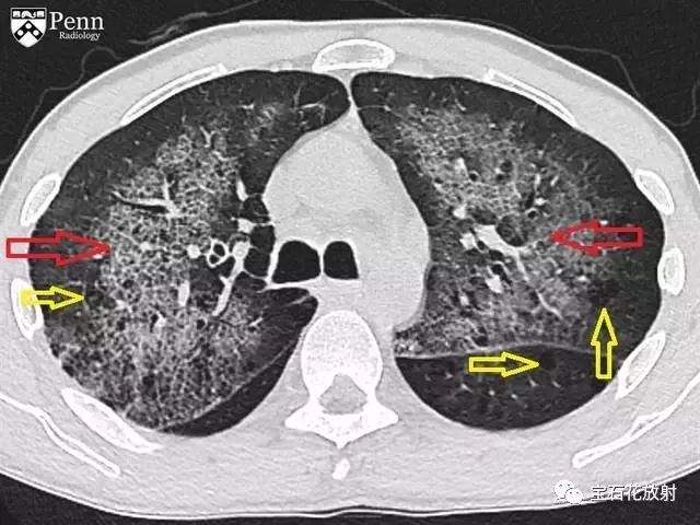 卡氏肺囊虫肺炎（PCP）影像表现